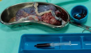 Insertio Velamentosa – Komplikationen mit der Nabelschnur - Moms.de